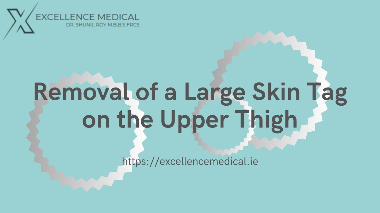 Removal Of Large Skin Tag On The Upper Thigh Groin Area At Excellence