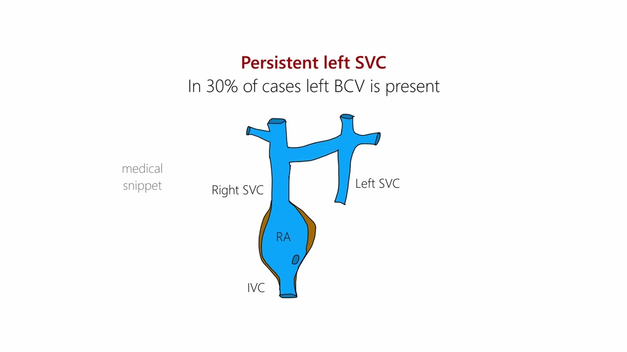 Bilateral Superior Vena Cava Is This Rare Condition Serious