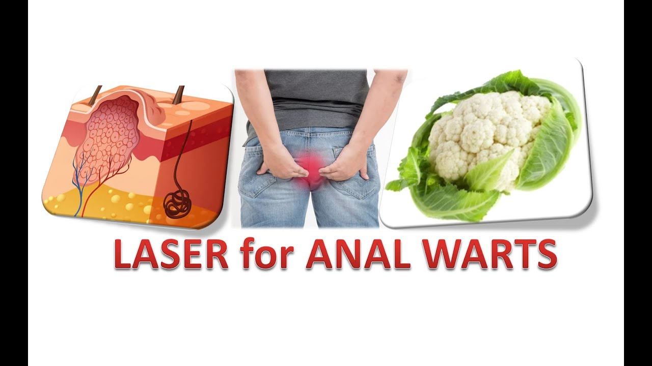 Anal Warts Condyloma Before And After Photo Of The Result