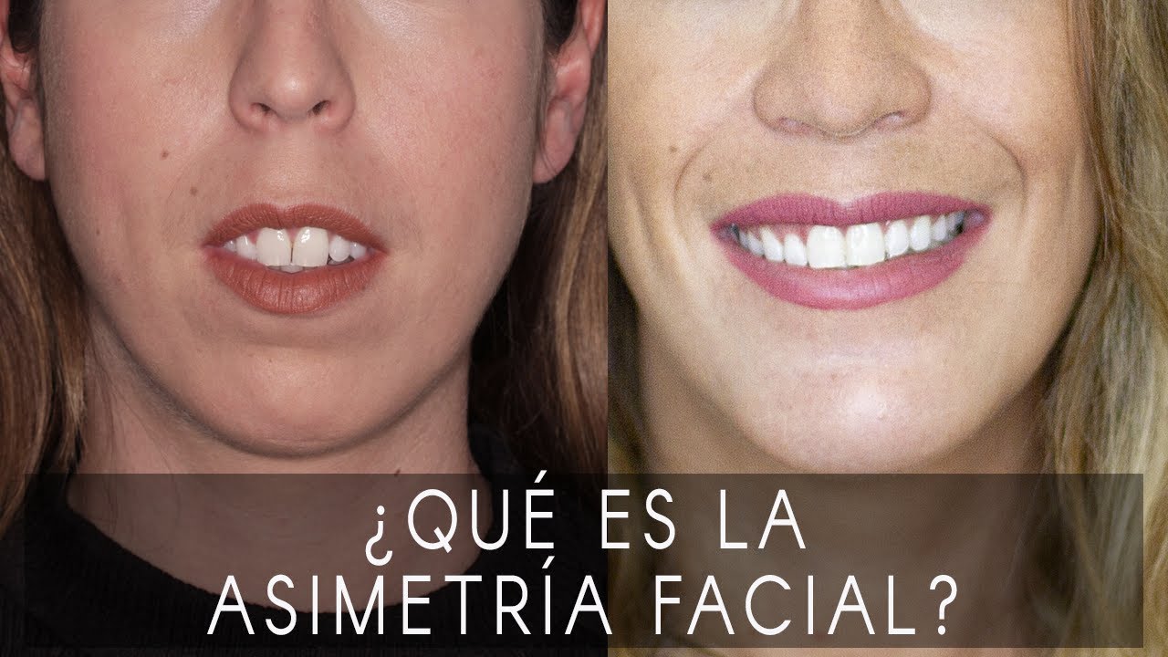 Asimetría Facial Qué Es Y Cómo Tener Un Rostro Simétrico Youtube