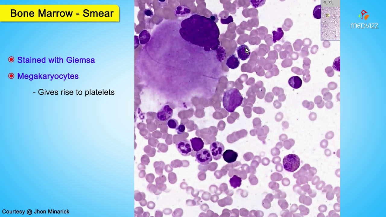 Normal Bone Marrow Cells