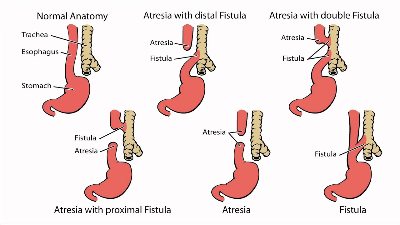 Esophageal Atresia What Is Esophageal Atresia Youtube