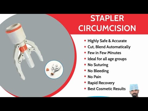 Stapler Circumcision By Dr N Satya Prasad Urologist Youtube