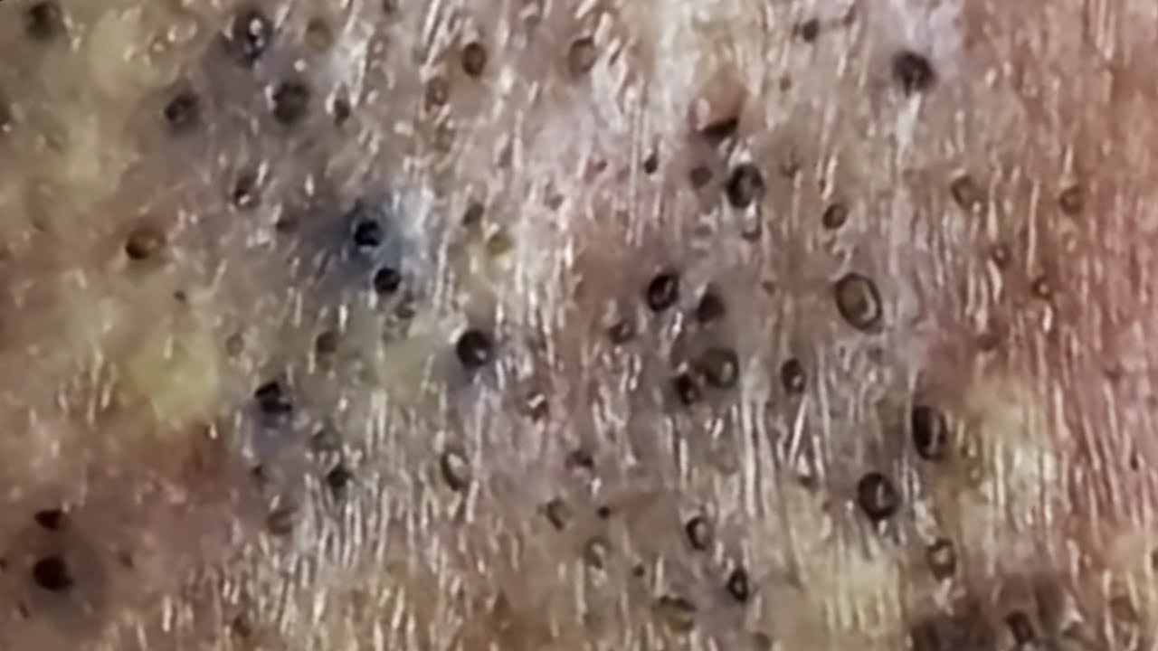 Satisfying Removal Blackheads Whiteheads 1029 Youtube