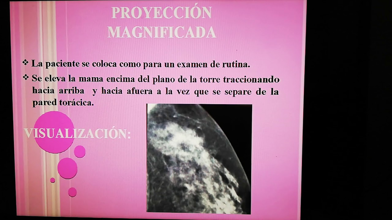 Proyecciones Básicas Y Complementarias En Mamografía Youtube