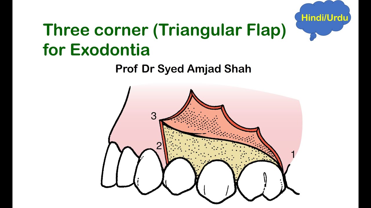 Three Corner Triangular Flap For Exodontia Oral Maxillofacial