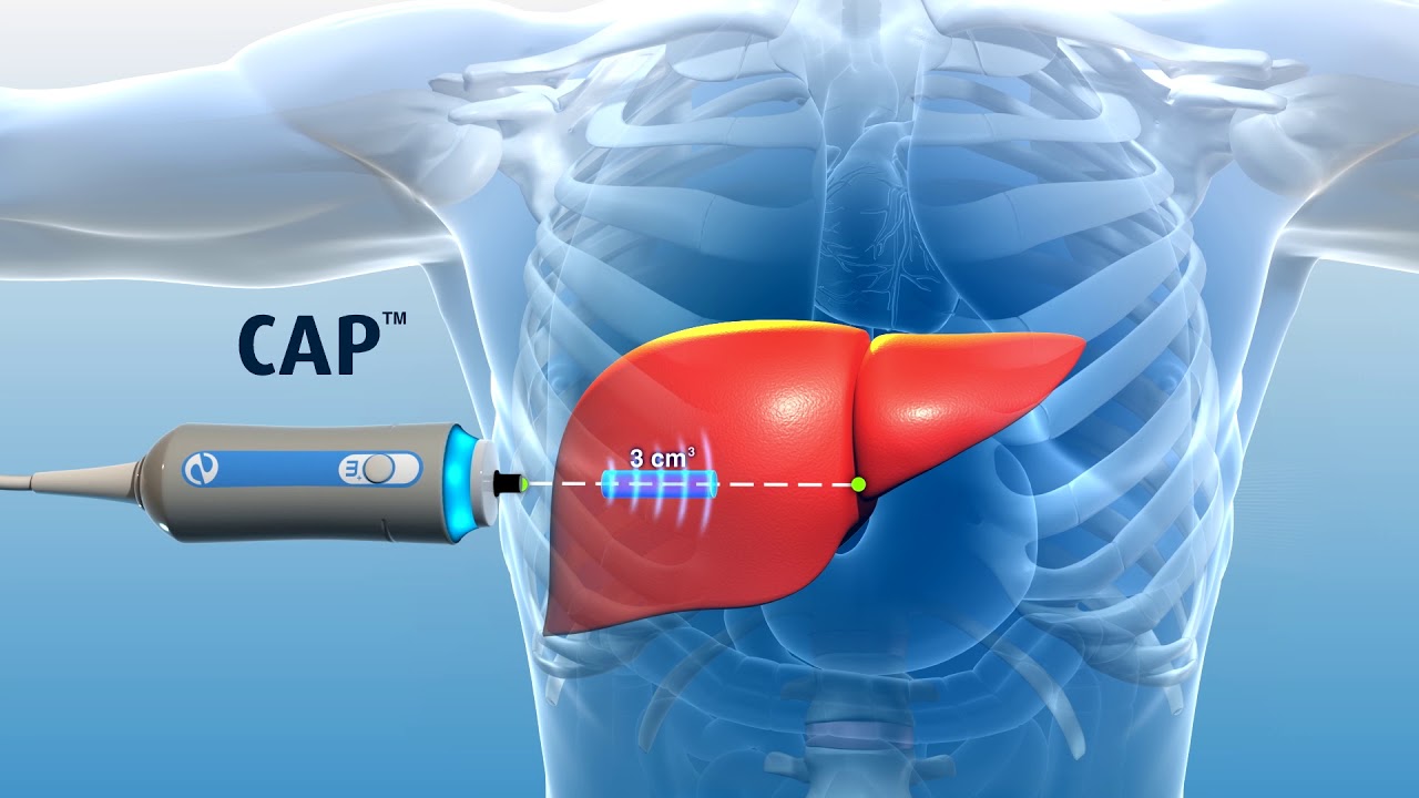A Patients Introduction To Fibroscan Youtube