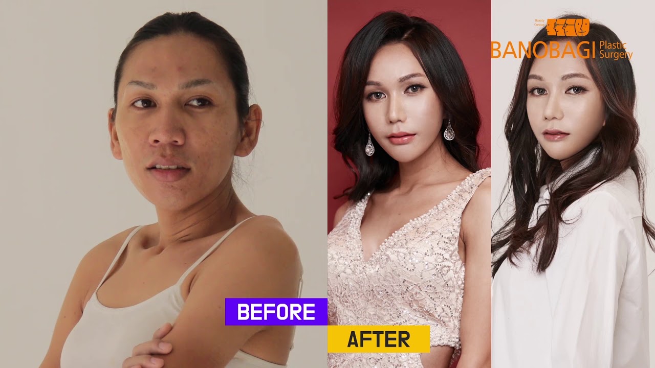 Extreme Plastic Surgery Before After Pics Lipstick Alley