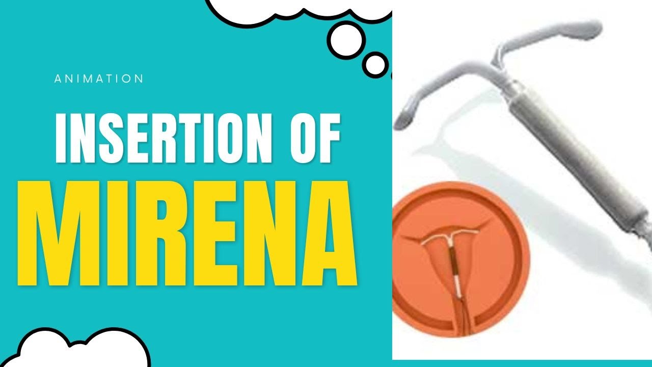 Mirena Insertion Animation Youtube