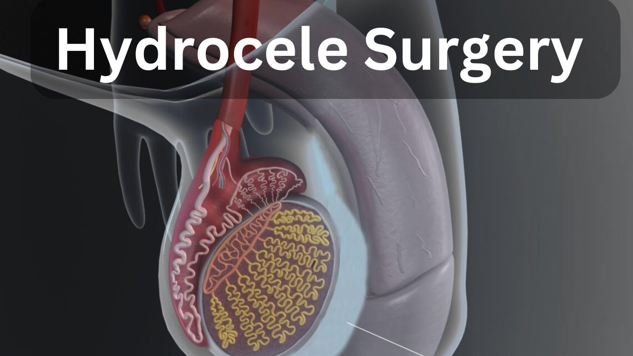 Hydrocele Surgery Hydrocele Testis Surgery Urology Surgery
