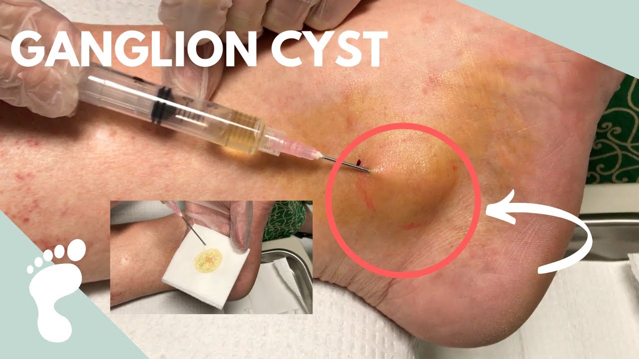 Hand Surgery Ganglion Cyst Removal At George Moss Blog