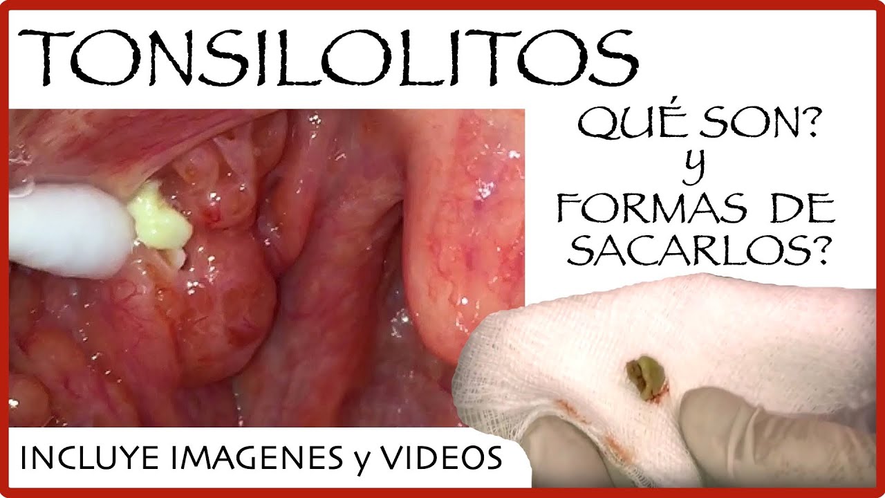 Tonsilolitos 2 0 Por Qué Salen Y Cómo Se Tratan Youtube