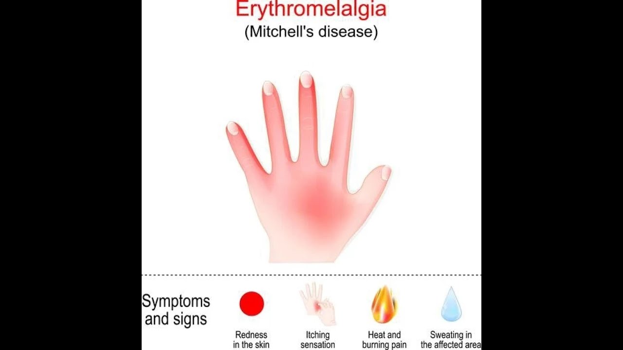 Erythromelalgia Or Mitchell S Disease Intense Burning Or High