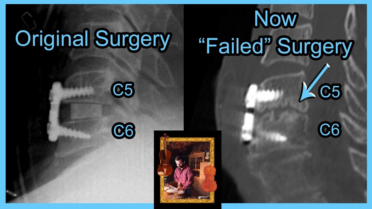 Neck Surgery C5 C6 C7 Recovery Time Renew Physical Therapy