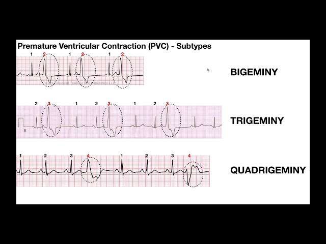 Premature Ventricular Contractions Trigeminy