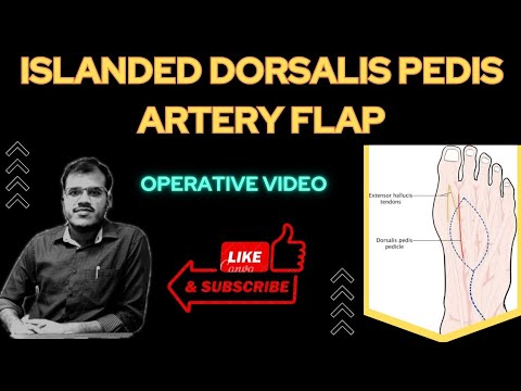 Dorsalis Pedis Artery Flap Youtube