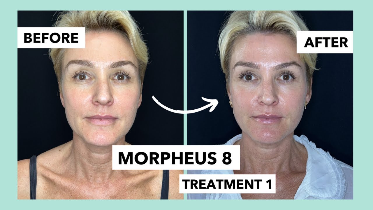 Scarlet Treatment Vs Morpheus At Rebecca Leon Blog