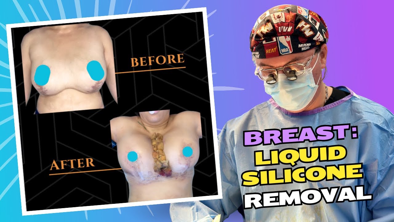 Uniboob Symmastia Correction After Liquid Silicone Injections