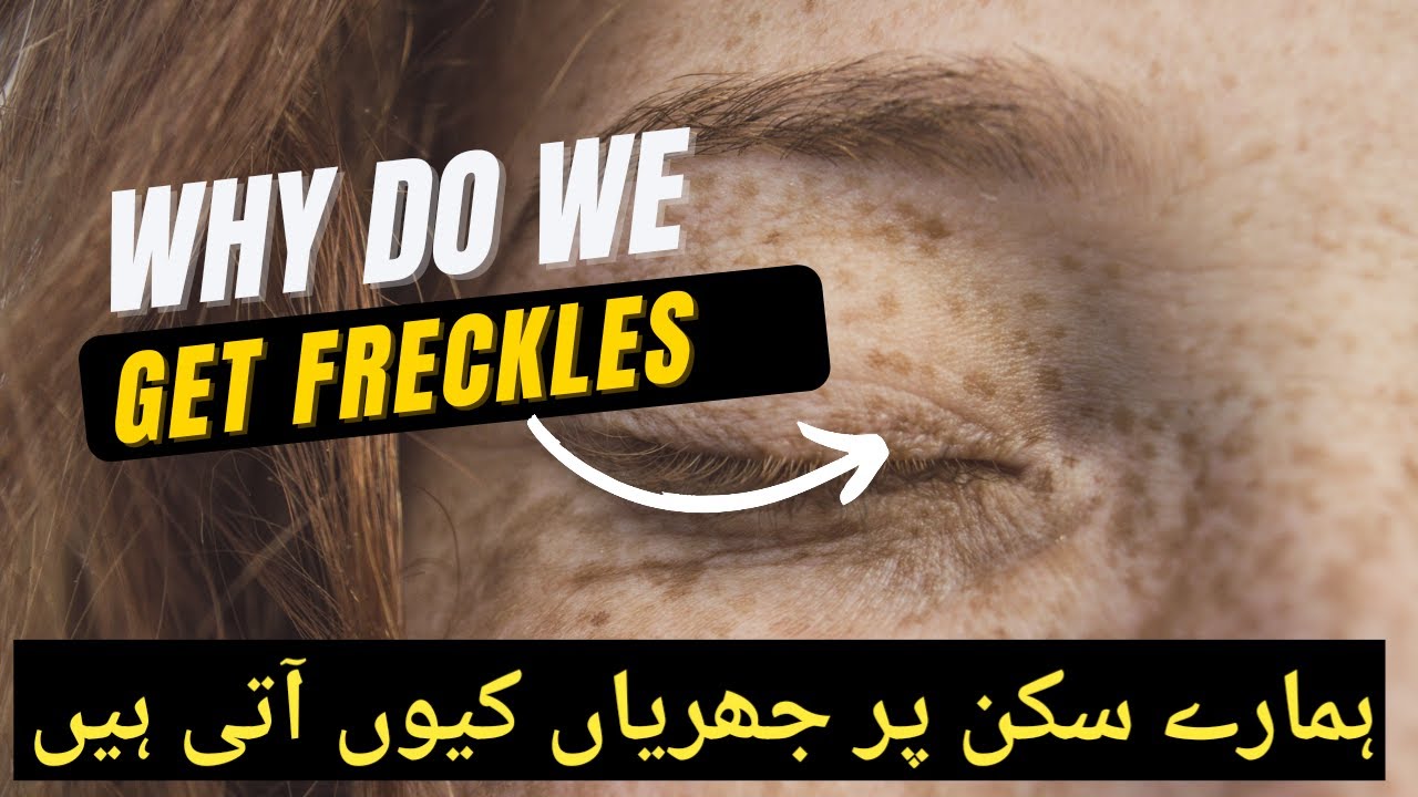 Why Do We Get Freckles Science Youtube