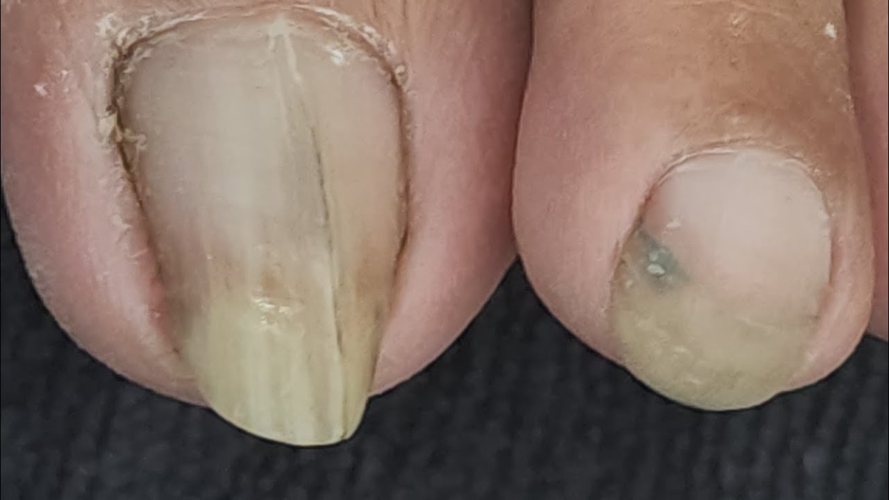 Satisfying Ingrown Toenail Removal Youtube