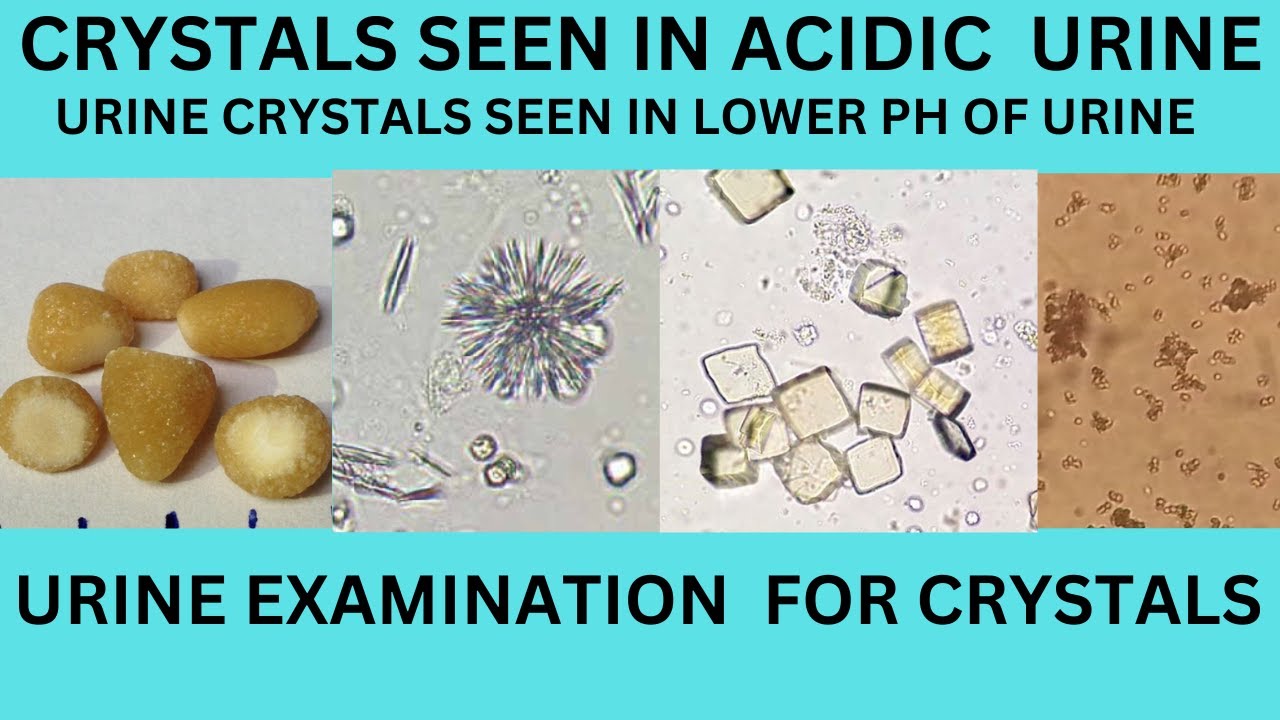 Crystals In Acidic Urine Causes Symptoms And Treatment Of Urinary