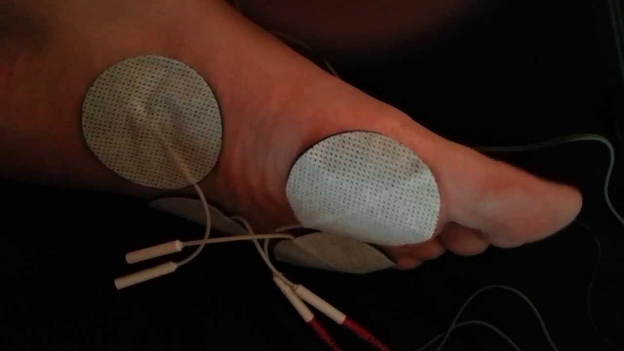 Electrode Placement For Nmes For Foot Drop At Russell Canter Blog