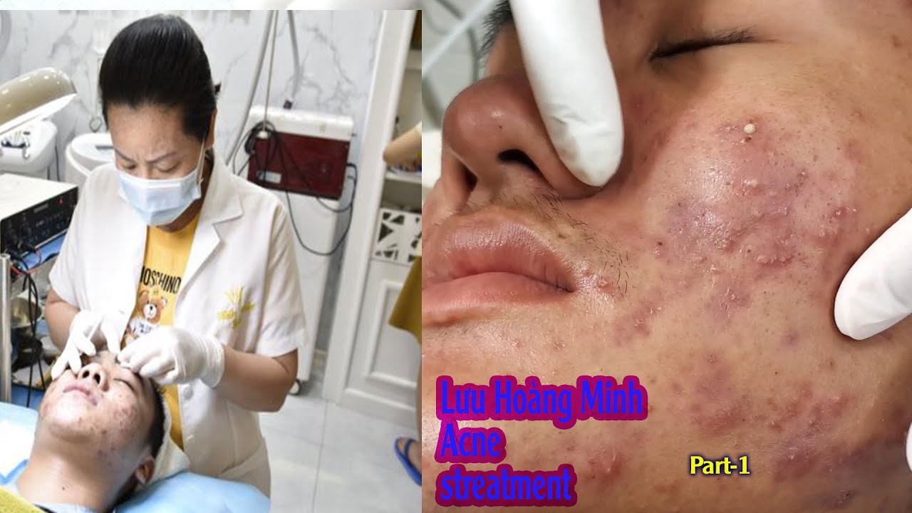 Acne Treatment Reputation Effective At Hien Van Spa 380i Lưu Hoàng