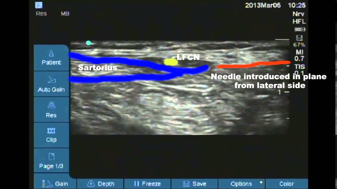 Ultrasound Guided Lateral Femoral Cutaneous Nerve Of Thigh Block Youtube
