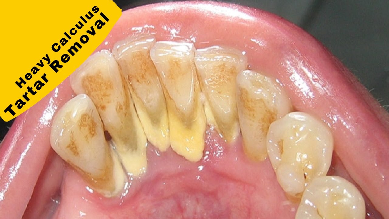Heavy Calculus Tartar Removal Dental Calaculus Removed With