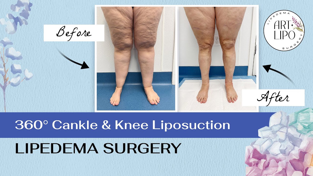360 Cankle Knee Liposuction Lipedema Surgery Artlipo Expert Dr