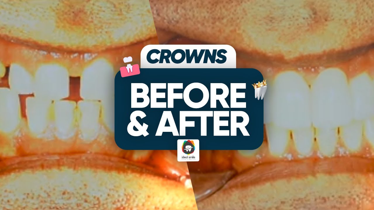 How To Fill Up Gap Between Teeths By Dr Aqib Mudassar Dental