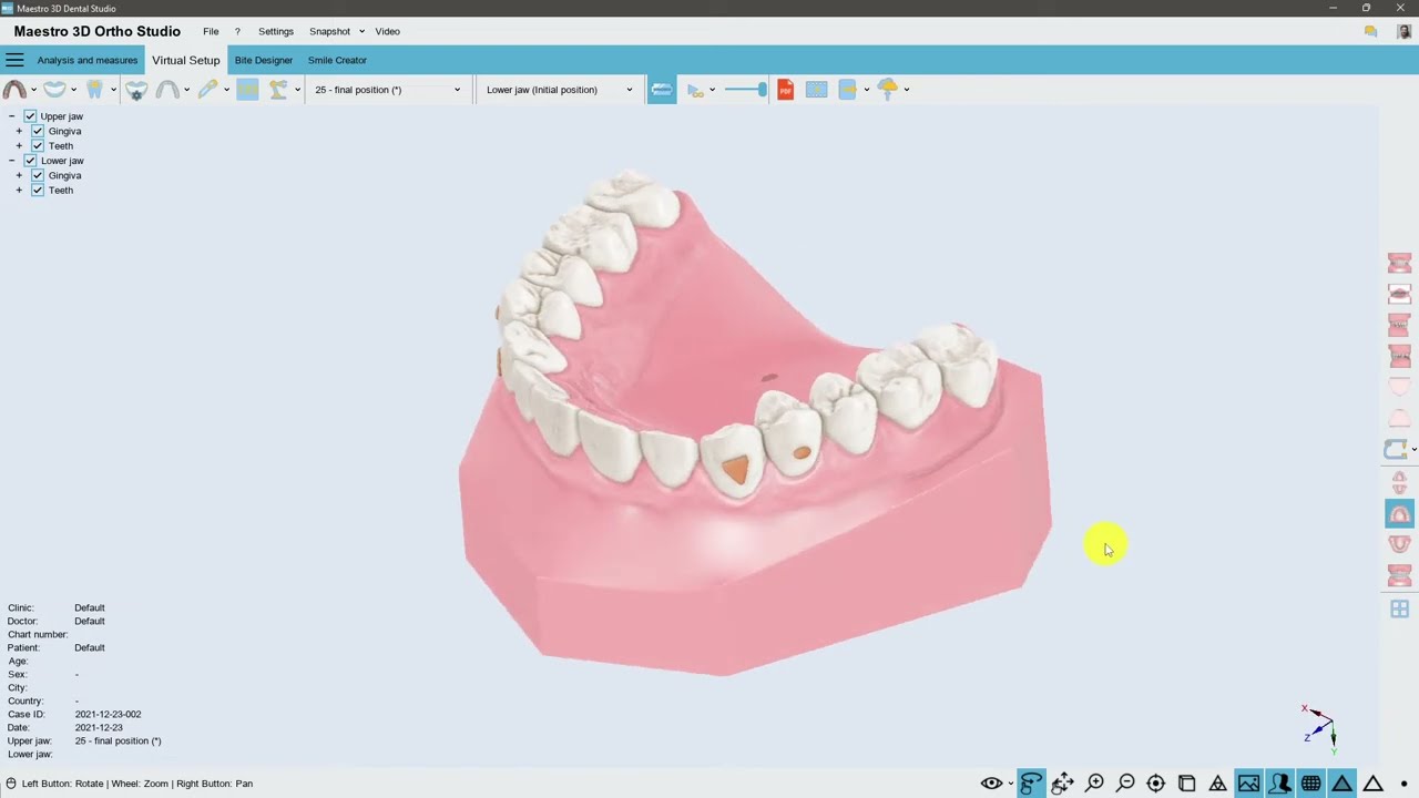 Maestro 3d Dental Studio Video Report Del Trattamento Youtube