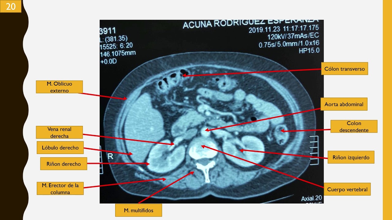 Anatomía Del Abdomen Y La Pelvis Por Tomografía Computarizada