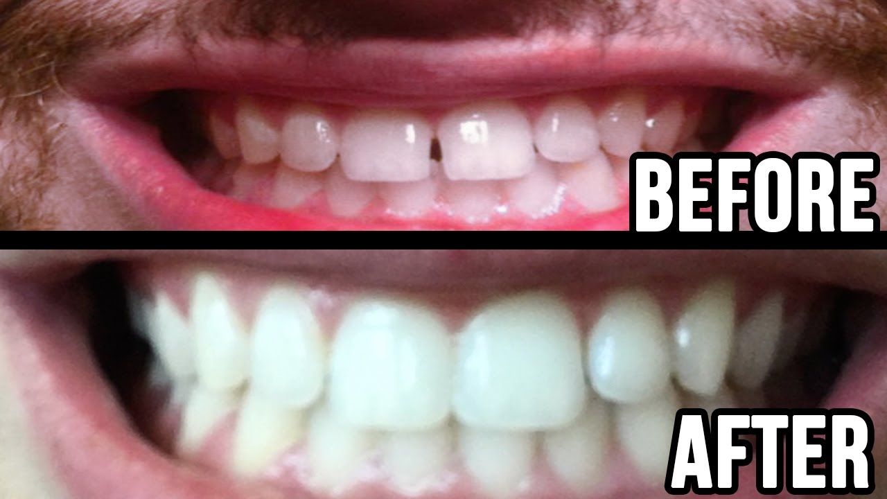 Closing Gap Teeth Without Braces At Herbert Hamilton Blog