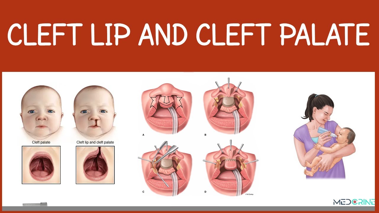 Cleft Lip And Cleft Palate Explained Causes Diagnosis Management
