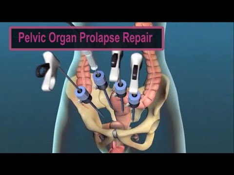 Pelvic Organ Prolapse Surgical Treatment 3d Animation Surgical