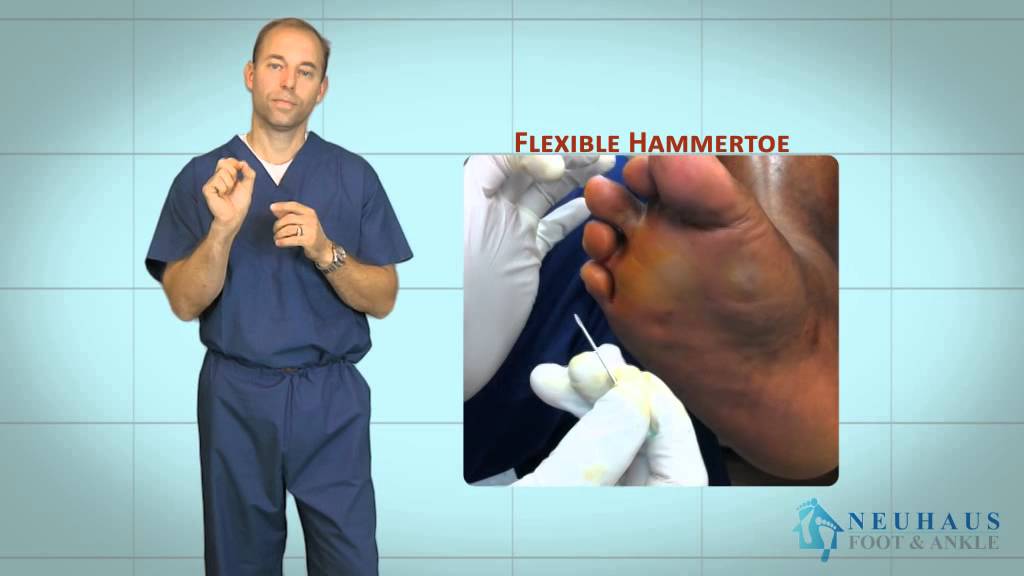 New Hammertoe Correction Procedure Performed In The Office Youtube