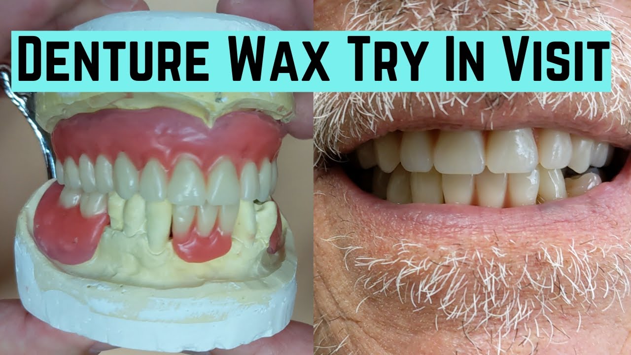 Denture Wax Try In Visit Youtube