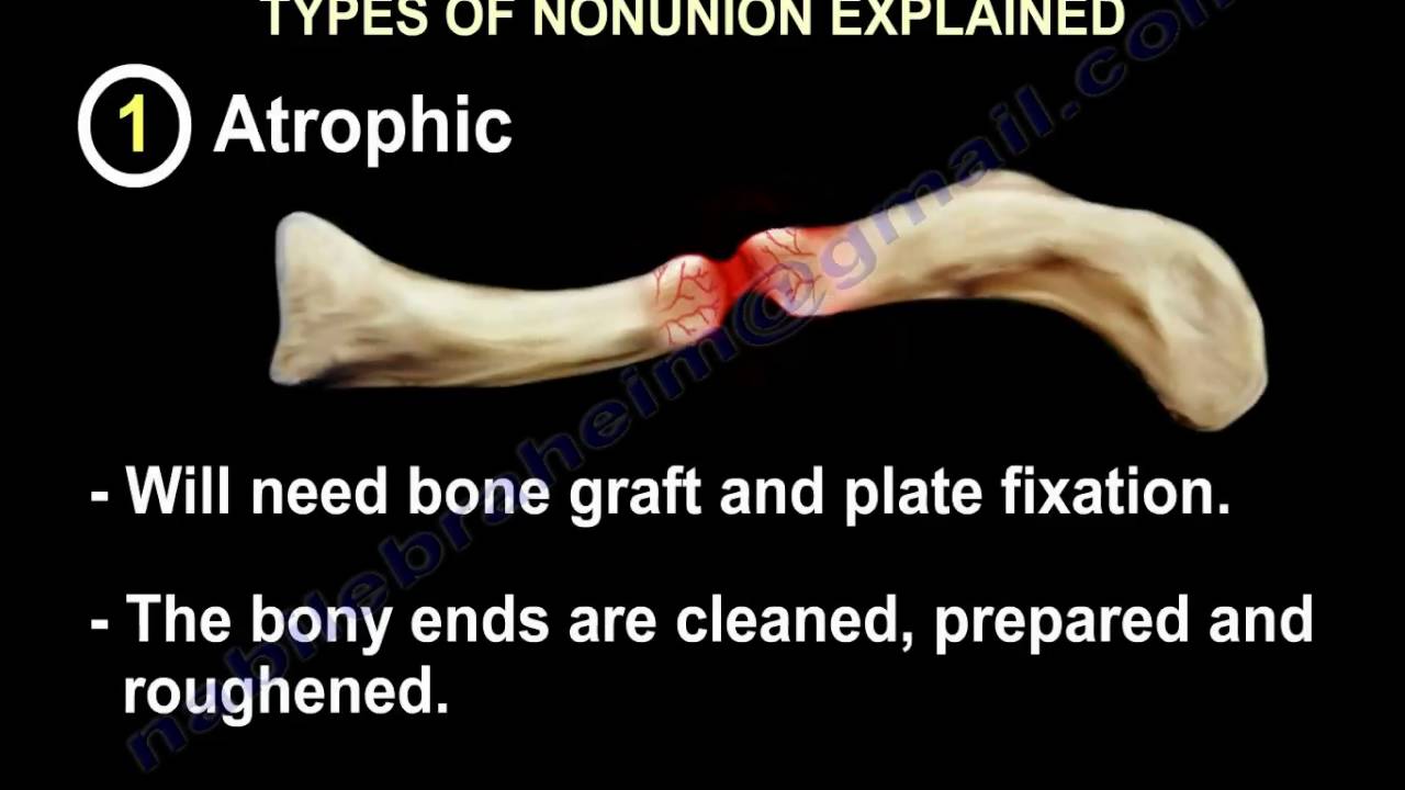 Nonunion Of The Clavicle Everything You Need To Know Dr Nabil