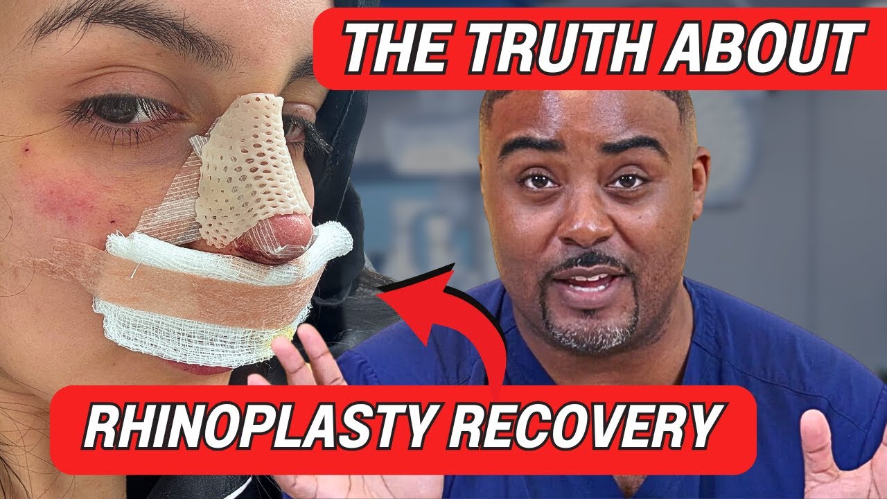 Rhinoplasty Recovery The Honest Timeline What To Really Expect Youtube
