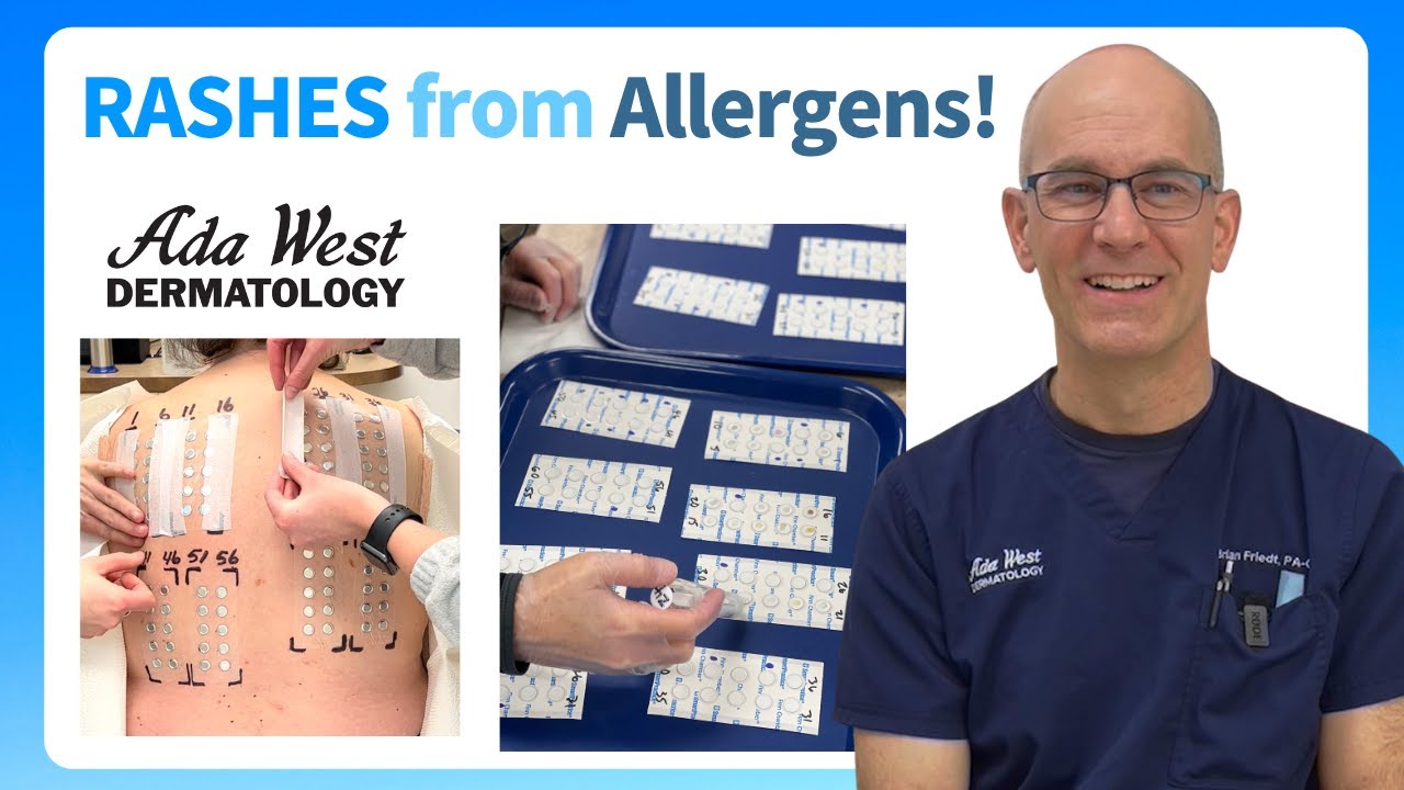 Patch Testing For Skin Allergy In Boise With Ada West Dermatology Youtube