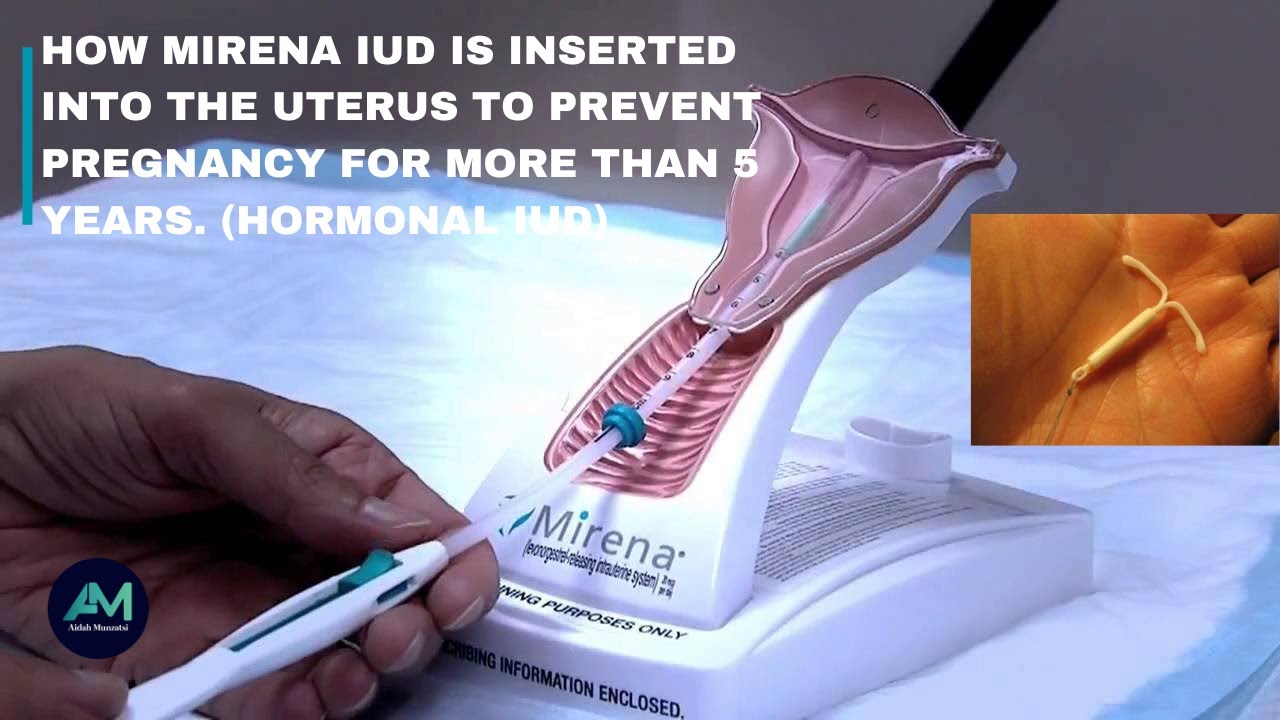 Mirena Iud Insertion Facts And Myths Explained Prevents Pregnancy