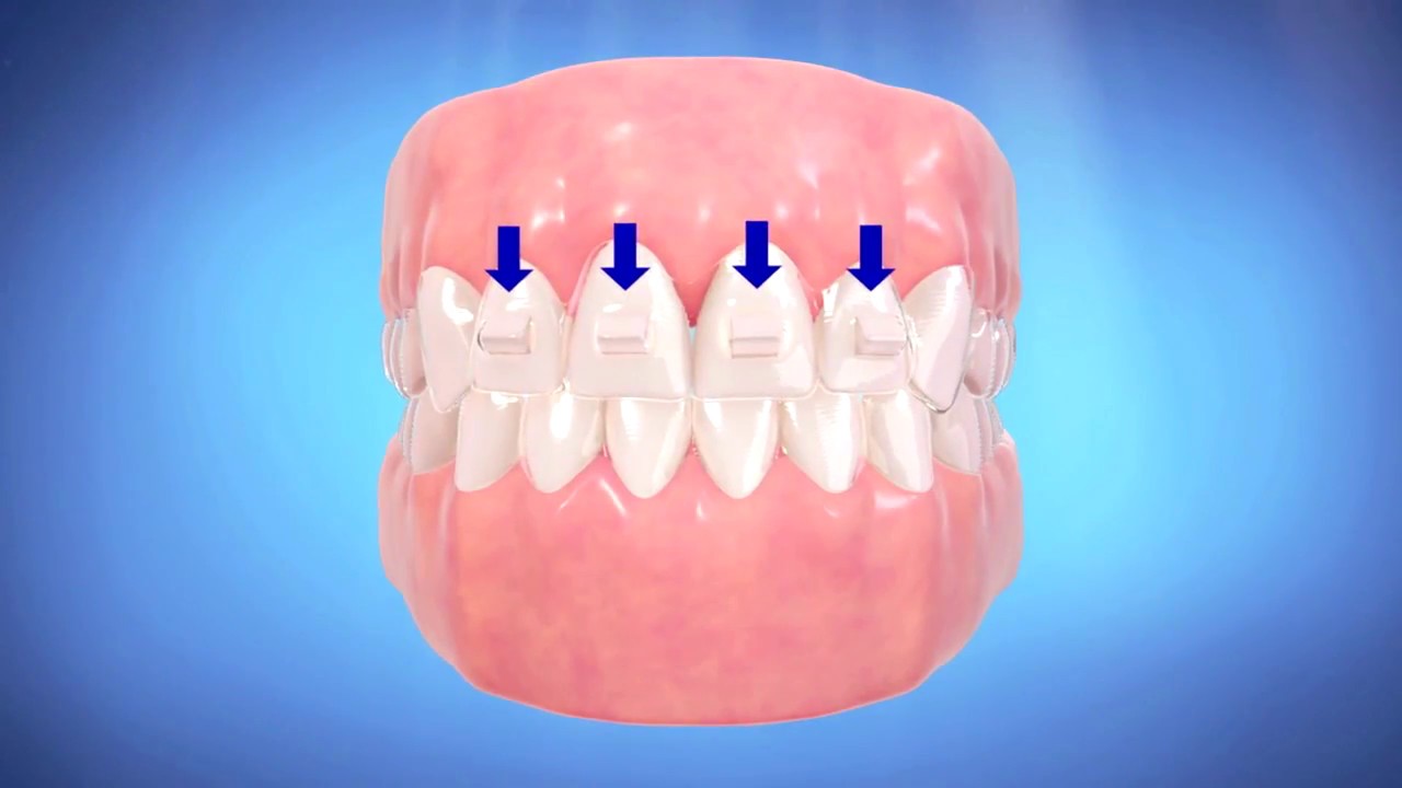 Invisalign Smarttrack Jp Full Youtube