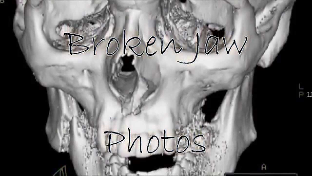 My Broken Jaw X Rays Youtube
