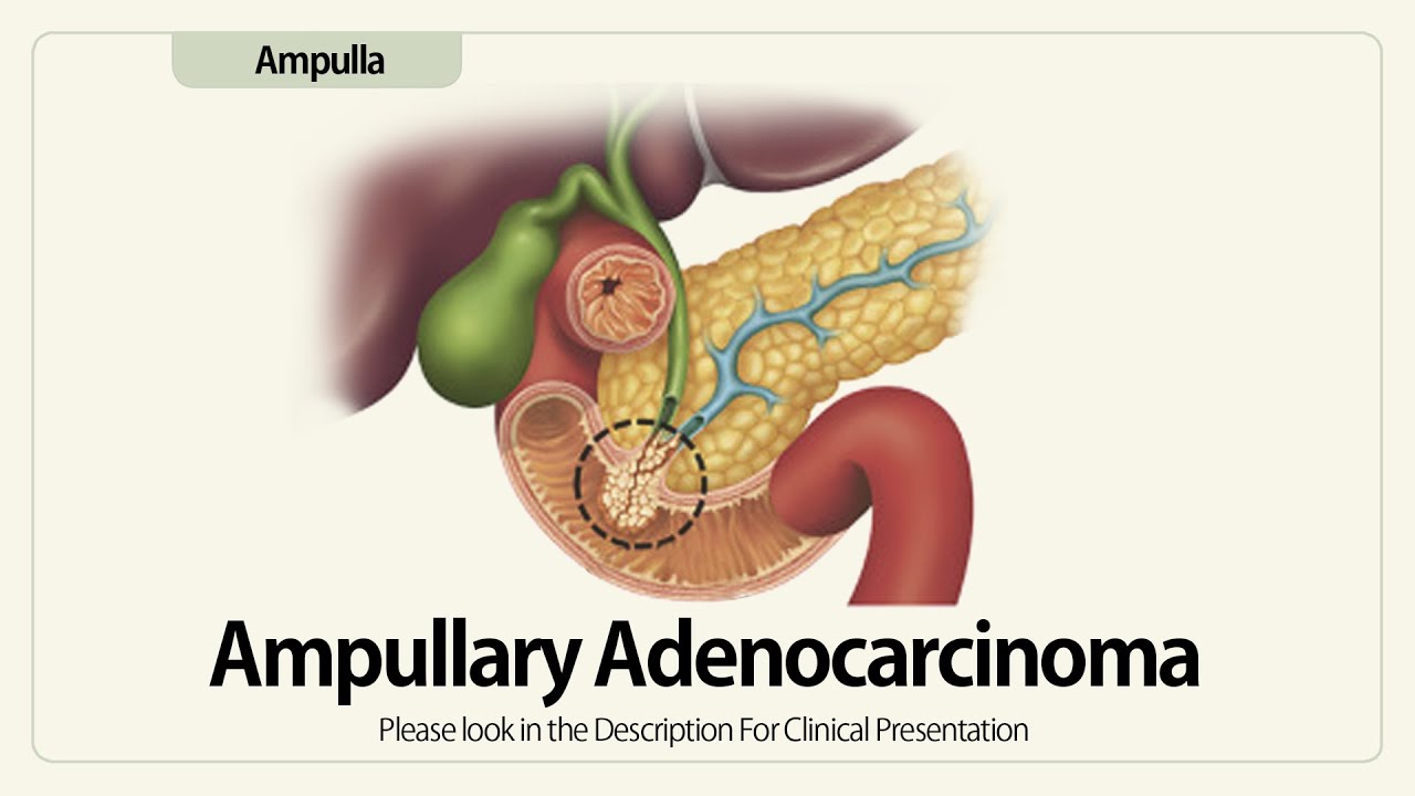Ampullary Adenocarcinoma Youtube