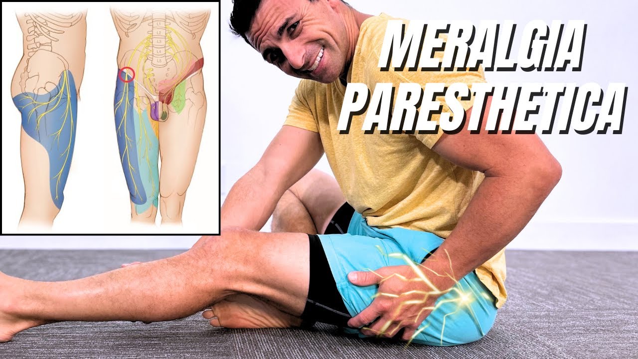 Tingling Or Numbness Outer Thigh Meralgia Paresthetica You Need To