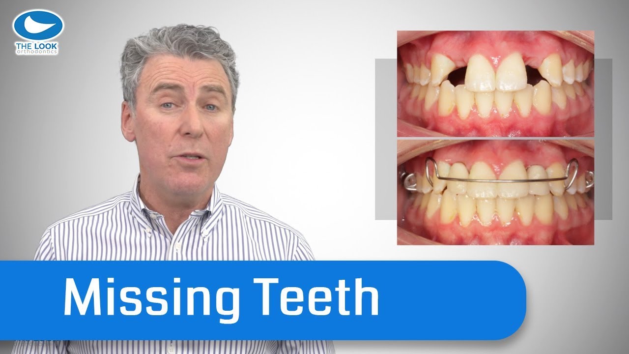 Braces Incomplete Teeth At Tanya Serna Blog