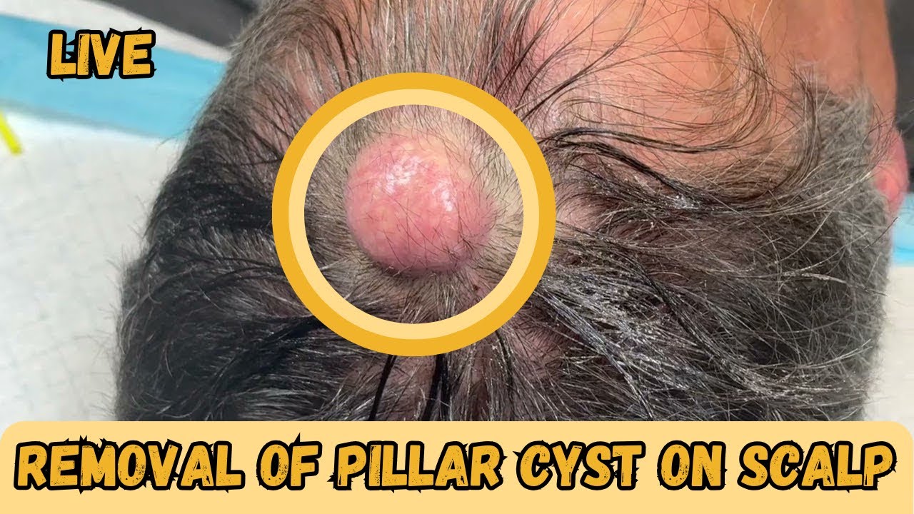 Removal Of A Decent Sized Pilar Cyst On The Scalp Step By Step