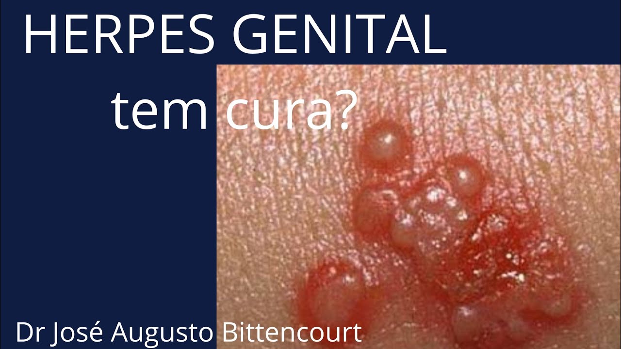 Herpes Na Regiao Pubiana Genital Herpes