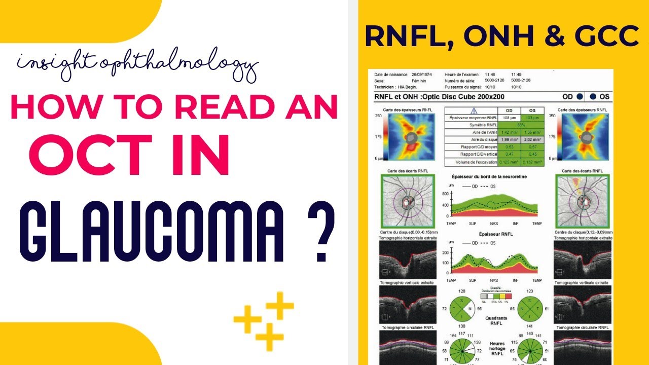 How To Read An Oct Printout In Glaucoma Stepwise Extremely Easy